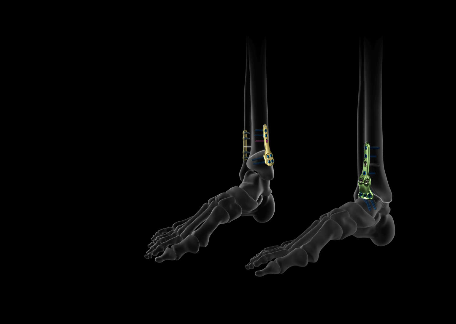 Ankle solutions - Newclip Technics