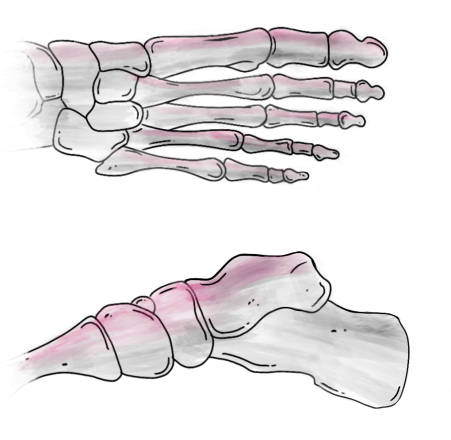 Footmotion Plating System - foot surgery Newclip Technics