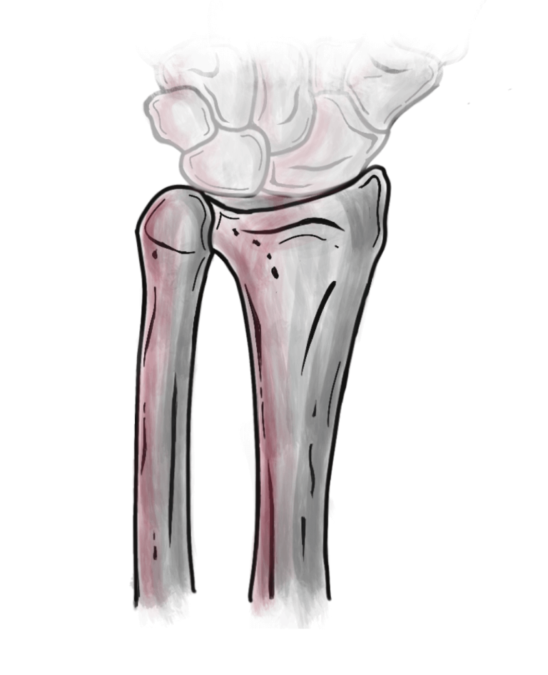 Xpert Wrist 2.4 - plates for the Wrist - Newclip Technics