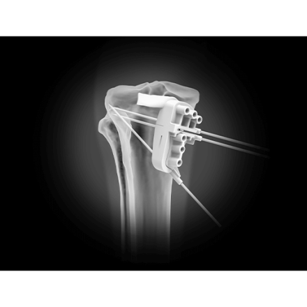 Activmotion S - Osteotomy plates - Newclip Technics