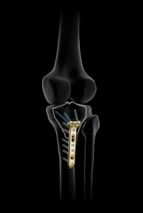 Xpert Knee. - Newclip Technics