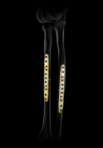 Alians Forearm. - solution for surgery - Newclip Technics