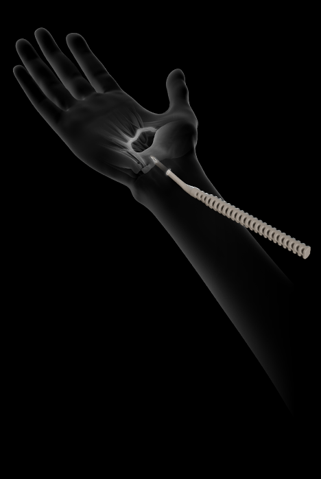 Kemis - Soft tissues surgery - Newclip Technics