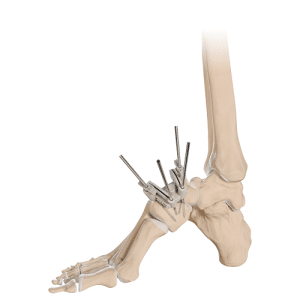 Footmotion Plating System. - foot surgery Newclip Technics