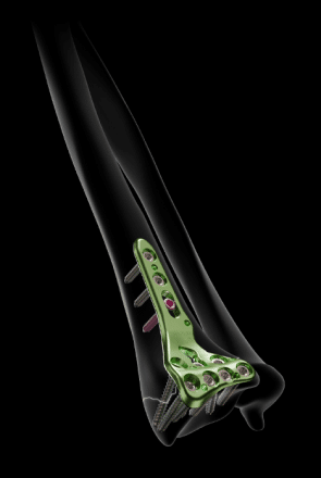 Xpert Wrist. - plates for the Wrist - Newclip Technics