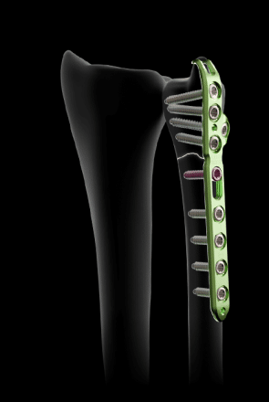 Xpert Wrist. - plates for the Wrist - Newclip Technics