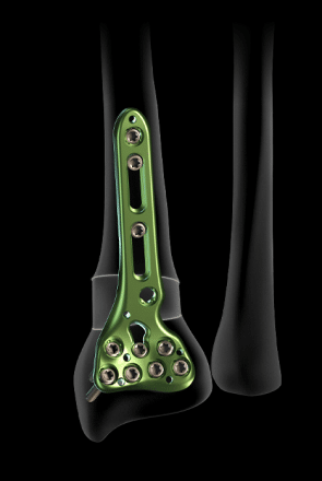 Xpert Wrist - plates for the Wrist - Newclip Technics