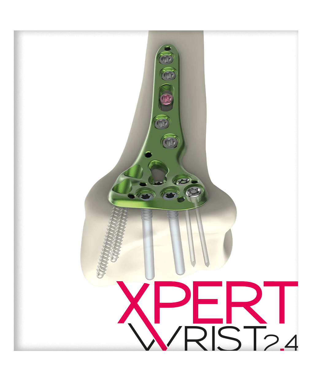 Wrist Fractures - Newclip Technics