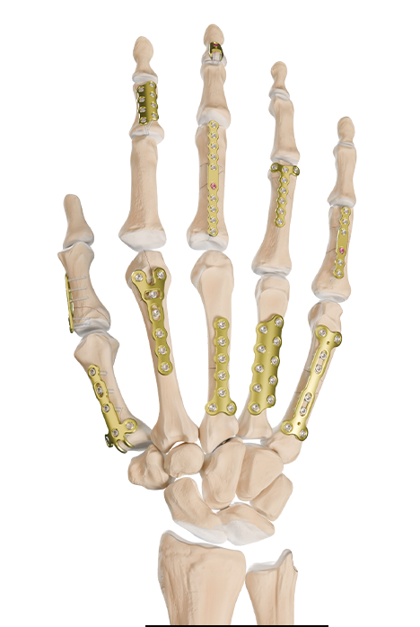 Upper Limb. - Newclip Technics