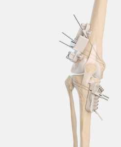 PSI - Patient-Specific Solution. - Newclip Technics