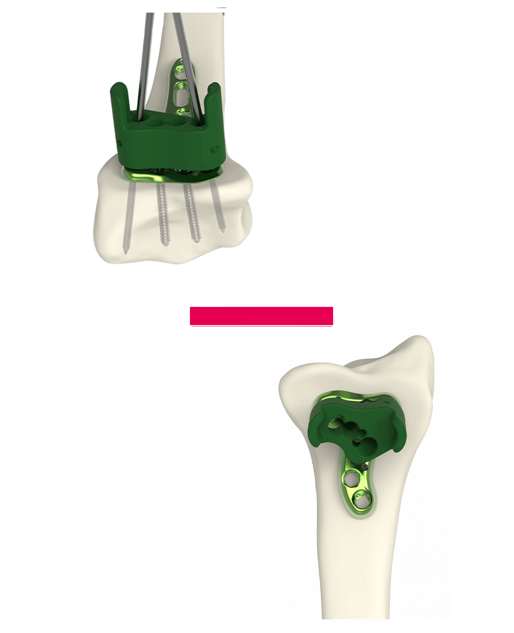 Xpert Wrist 2.4 - Specific Instruments - Newclip Technics